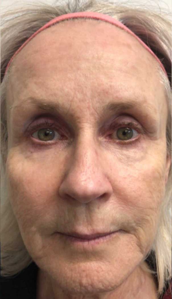 Controlled Depth Peel - SkinRhümMD