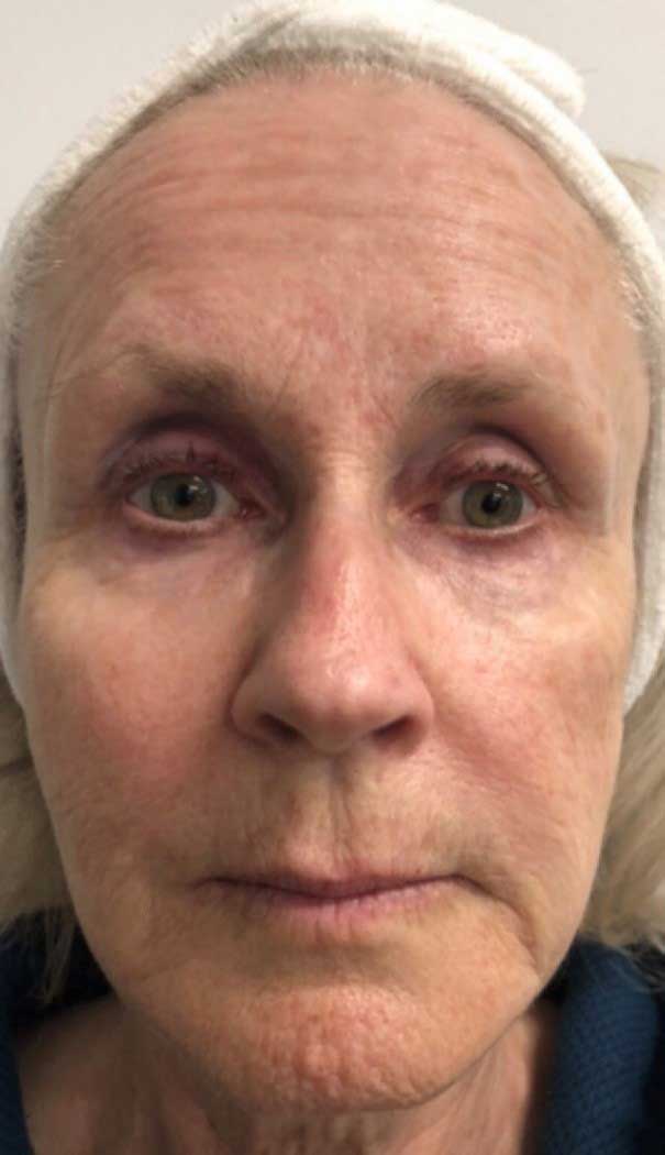 Controlled Depth Peel - SkinRhümMD